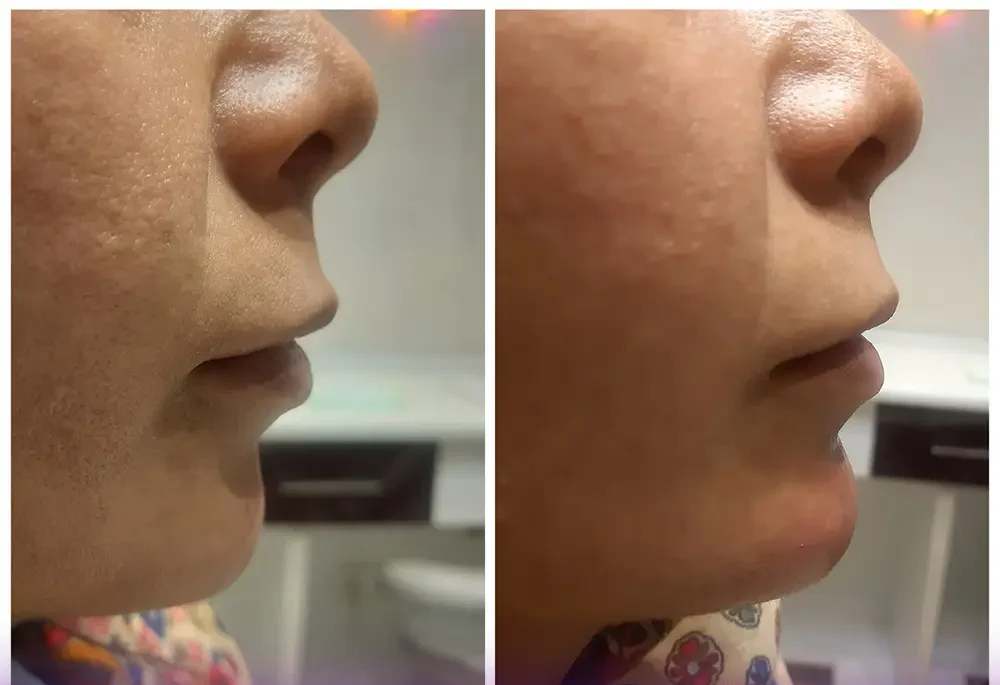 Filler Injections for Volume – Cost, Benefits, Side Effects, and Longevity