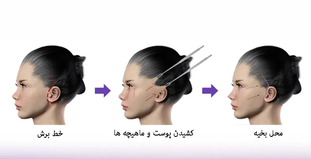 Temple Lift with Thread | Non-Surgical Facelift for Youthful Contours