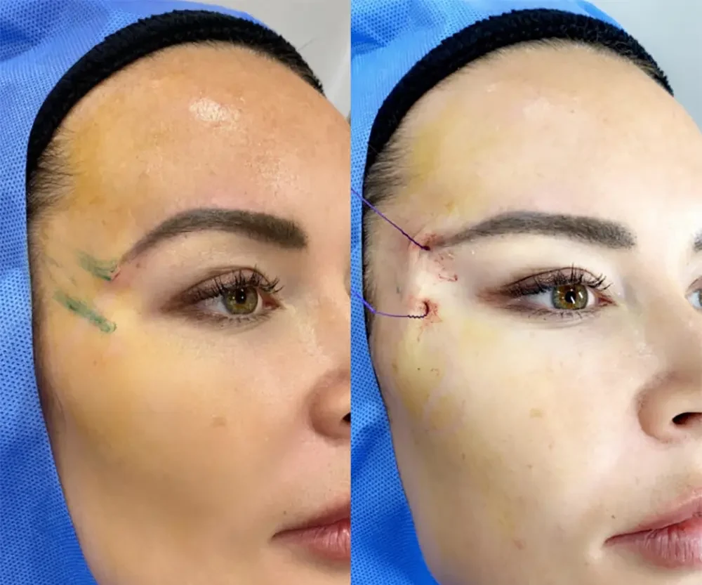 Temple Lift with Thread | Non-Surgical Facelift for Youthful Contours